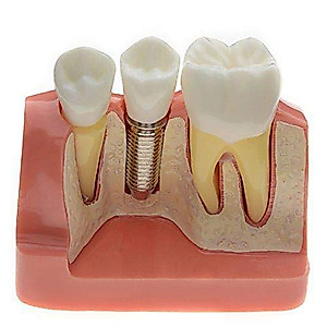 1 PCS Dental Model Implant Analysis Crown Bridge Demonstration Teeth Model for Education