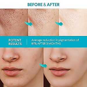 Rejopes Dark Spot Corrector Remover for Face and Body, Dark Spot Remover with Natural Ingredients,1.7 Fl Oz