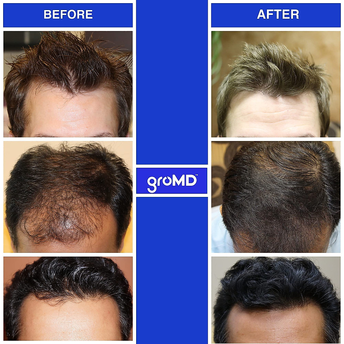 GroMD Follicle Activator Spray & Hair Growth Stimulating Shampoo and Conditioner Bundle - Biotin, Argan Oil, Copper Peptides, DHT Blocker for Regrowth, Doctor Formulated for Minimizing Thinning