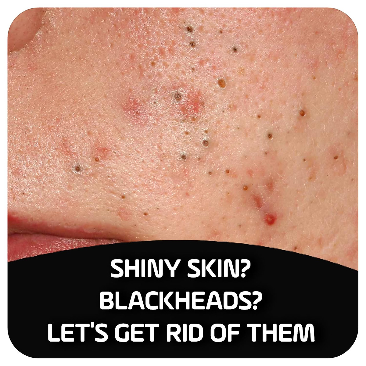 Asepxia Activated Charcoal Cleansing Bar for Enhanced Acne Control & Skin Purification with 2% Salicylic Acid, Ideal for Oily Skin and Reducing Blackheads - 4 Oz, 5-Pack