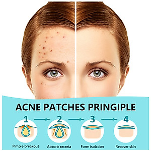 180 Counts Pimple Patches for Face Hydrocolloid Acne Patches for face Invisible Zit Patches for Face Pimple Patch Acne Spot Treatment Patch Blemish Patches Cover Patches Stickers