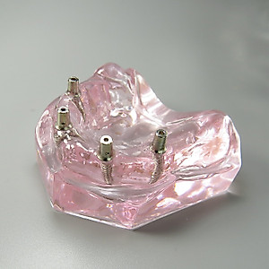 Dental Model Overdenture Upper Teeth 4 Implants Demo for Teaching and Studying