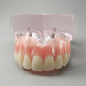 Dental Model Overdenture Upper Teeth 4 Implants Demo for Teaching and Studying