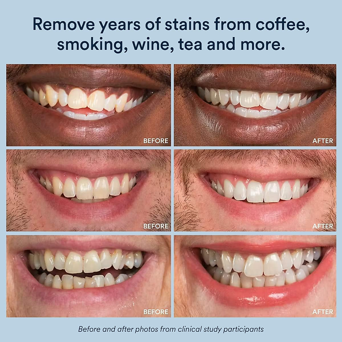 Auraglow 35% Teeth Whitening Gel Syringe Refill Pack, 35% Carbamide Peroxide, 30 Whitening Treatments, (3) 5mL Whitening Gel Syringes, Sensitive Teeth Whitening