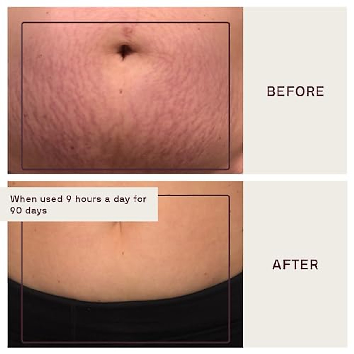 Dermaclara Large Body Patch - Pregnancy Stretch Mark Prevention & Removal, C Section Cover Up Belly Scar, Maternity Skincare, Silicone Gel Sheet, Reusable up to 30 Times - 2 Patches & Patch Cleanser