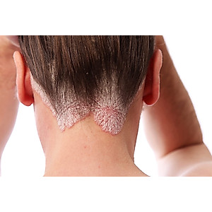 Prosoria Medicated Shampoo Relieves and Prevents Flaking, Scaling, Dry, Itchy Scalp Psoriasis Symptoms and Dandruff while Revitalizing and Moisturizing Scalp and Hair. Maximum Strength 6oz bottle