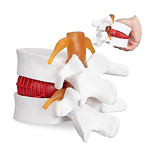 LVCHEN Disc Herniation Model - Human Lumbar Disc Herniation Spine Model 1.5X Intervertebral Disc Model Anatomical Vertebrae Disc Model with Elastic Software