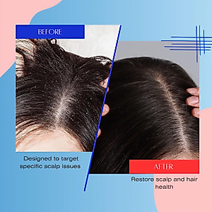 Mediceuticals Solv-X Shampoo - For Oily Hair and Scalp - Scalp Acne Shampoo for Men, Women and Teens 8.45 oz (250 ml)