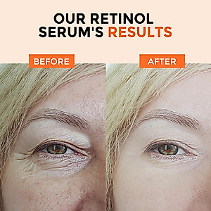 Retinol Serum for Face 2.5%, B5 Resurfacing Retinol Serum with Vitamin C, Vitamin E, Hyaluronic Acid, Niacinamide, Serum for Anti-Aging, Wrinkle Smoothing, Dark Spot Corrector, Brighten Dullness