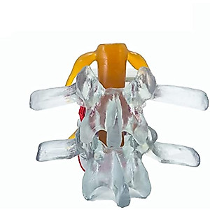 DenFactory Human 1.5 Times Life-Size Transparent Lumbar Disc Herniation Spine Model for Teaching and Learning