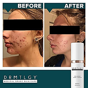DRMTLGY Acne Spot Treatment and Cystic Acne Treatment. Acne Serum with Micronized Benzoyl Peroxide 5% and Glycolic Acid