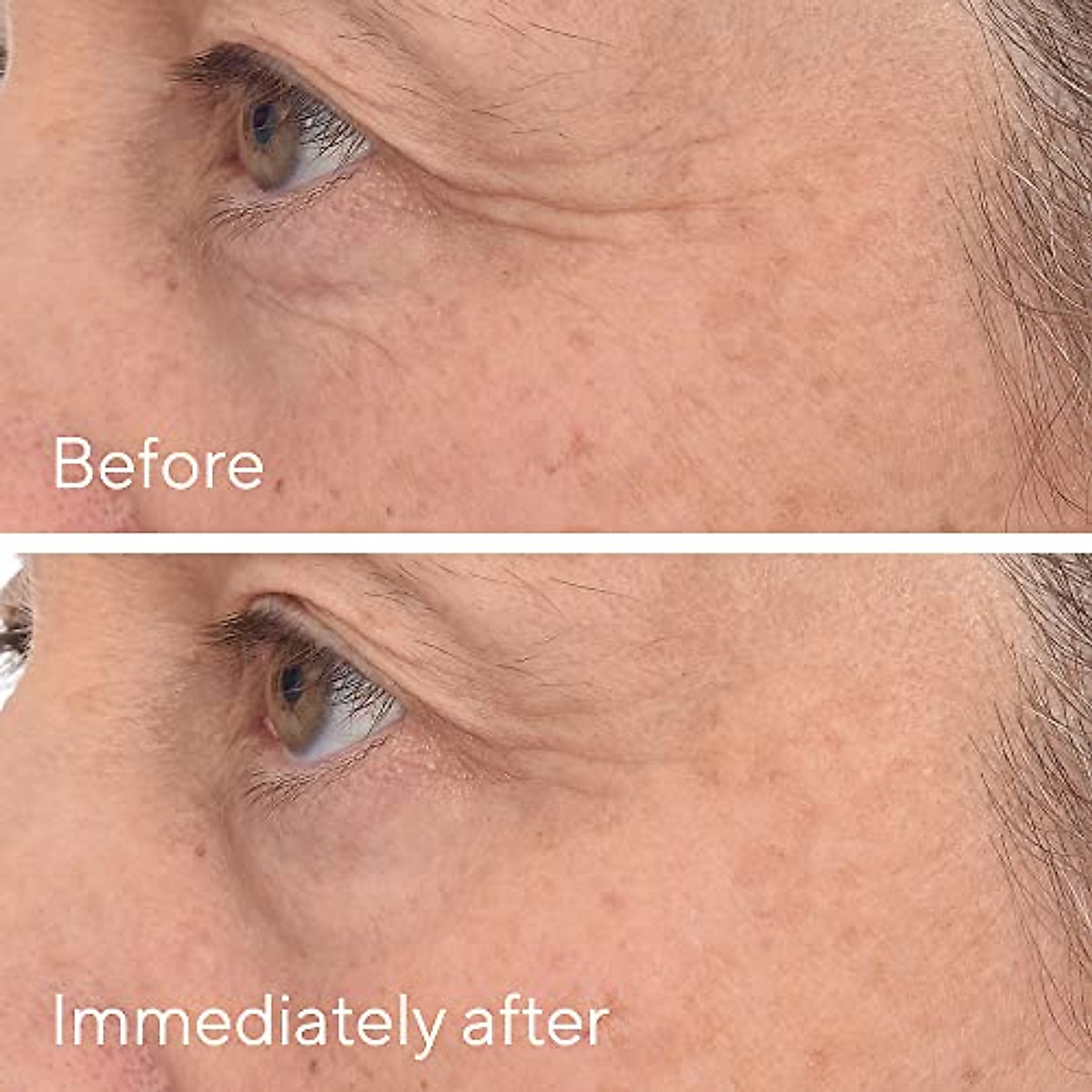 Murad Dr. Zion Retinol Youth Renewal Eye Masks – No-Slip Under Eye Patches for Fine Lines, Wrinkles, Crow’s Feet and Puffy Eyes - Full Absorption Treatment Strips, 5 Pairs