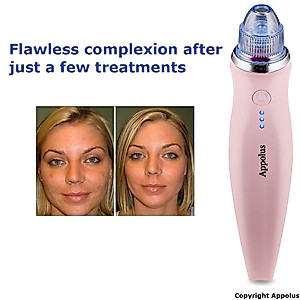 Microdermabrasion Machine - Appolus Premium Diamond Microdermabrasion Device for Flawless Glowing Skin - 2 Diamond Tips - 5 Heads - Anti-Aging - Pore Lines Wrinkles Sagging Minimizer