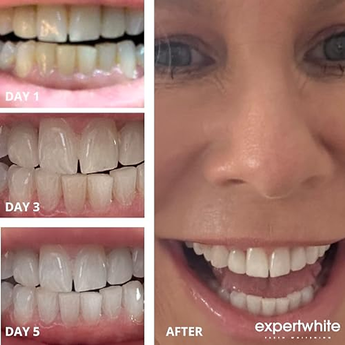 Expertwhite Teeth Whitening Gel Refills (6-gels). Made USA. 44 percent Carbamide Peroxide Tooth Bleaching Gel bleach For Invisalign style trays, Dental Grade Tooth Whitener. 6 syringes