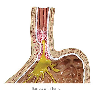 GPI Anatomicals - 4-Piece Stomach Model Set with Gastroesophageal Reflux Disease (GERD), Replica for Human Anatomy and Physiology Education, Anatomy Model for Doctor's Offices, Medical Study Supplies