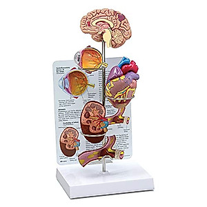 GPI Anatomicals - Hypertension Model Set | Human Body Anatomy Replica of The Effects from High Blood Pressure for Doctors Office Educational Tool