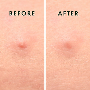 Rael Pimple Patches, Miracle Microcrystal Spot Cover - Hydrocolloid Acne Patch with Tea Tree Oil, Early Stage Zits and Blemish, Korean Skin Care, Vegan, Cruelty Free (27 Count)