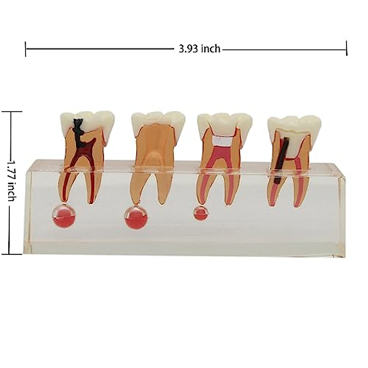 Dentalmall Dental 4-Stage Endodontic Treatment Model for Study Teach Teeth Model 4018 Root Canal Anatomy Demonstration Teaching Tooth Model