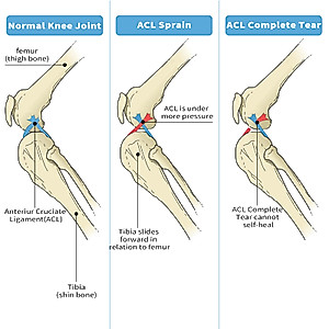 Noillow Dog Knee Brace, Dog Leg Brace for Sprain ACL, CCL, Arthritis - Keeps The Joint Warm and Stable, Leg Wounds Care and Prevent Licking, Dog Rear Leg Luxating Patella Brace-Right-L