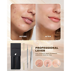 SGNEKOO Professional Facial Milia Removal Tool and Whitehead Extractor,Titanium Alloy Double Ended Needle and Steel Tweezers Kit,Blackhead,Blemish,Zit and Pimple Acne Remover Popper (Titanium Gold)