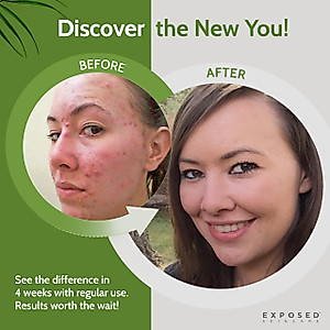 Exposed Skin Care Acne Treatment Kit - Includes Facial Cleanser, Clearing Tonic, Acne Treatment Serum, Clear Pore Serum, Clarifying Mask, Cloth - Natural Acne Solution for Face, All Ages & Skin Types