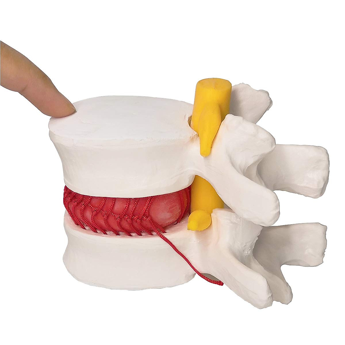 Human Herniated Disc Model, Anatomical Herniated Lumbar Vertebrae Disc Prolapse Model for Medical Teaching Learning, Kids Learning Education Display Toolning, Kids Learning Education Display Tool