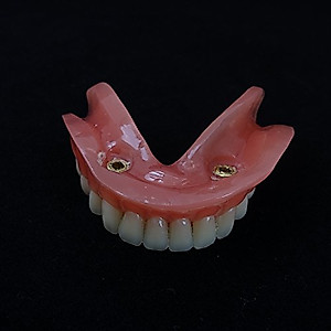 Smile1000 Dental Model Overdenture Inferior 2 Implants Demo for Studing and Teaching