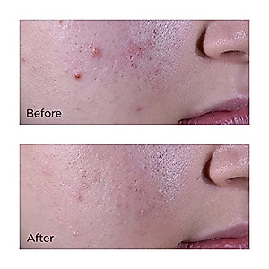 Perricone MD Acne Relief Maximum Strength Clearing Treatment, 1 oz.