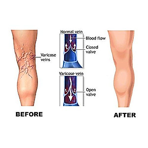 MGANG Compression Socks, 15-20 mmHg Graduated Knee High Compression Stockings for Unisex, Class I, Open Toe, Opaque, Support Hose for DVT, Pregnancy, Varicose Veins, Relief Shin Splints, Beige L