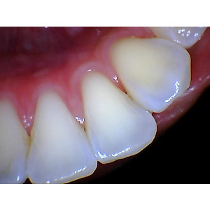 TELICAM Intraoral Camera Dental, Works with Eaglesoft, Dexis, Apeteryx, Carestream, Tigerview