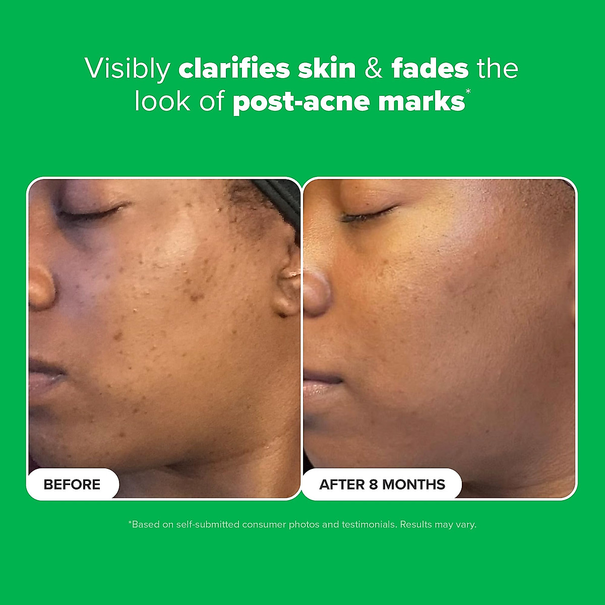 Paula’s Choice BOOST 10% Azelaic Acid Booster Cream Gel, Oil-Free Serum Fades Discoloration & Post-Blemish Marks, with Licorice Extract & Salicylic Acid, Fragrance-Free, 0.17 Fl. Oz.