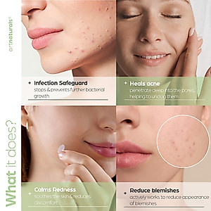 Artnaturals Acne Pimple Patches (144 Pack) Hydrocolloid Acne Patches with Tea Tree Treatment for Zits and Breakouts, Spots and Dots Stickers for Face and Skin