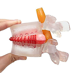 MIIRR Human Lumbar Disc Herniation Model, Transparent Medical Model of Vertebral Spine Anatomy with Elastic Software, Perfect for Learning and Teaching Tool
