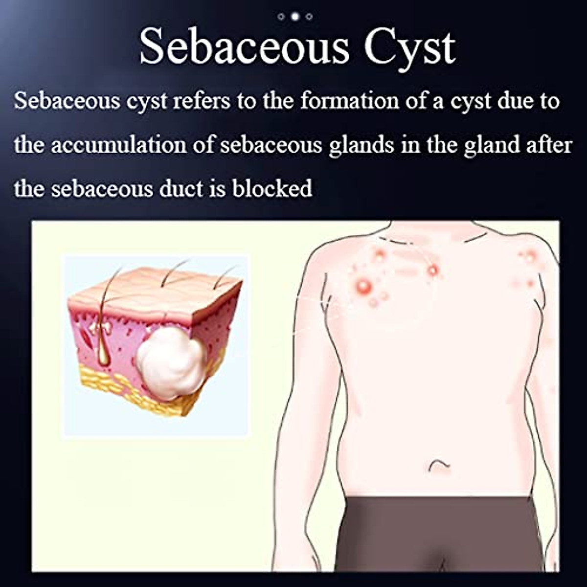 Model Teaching Model Cyst Model Skin Cyst Excision Model Training Suture Pad Skin Model Lipoma Model for Medical Practice for Teaching