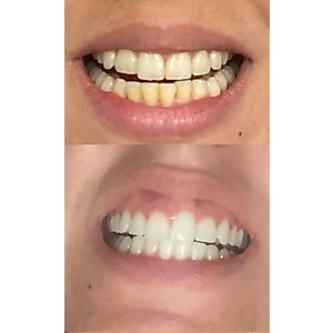 Smile Titan Teeth Whitening Kit, Teeth Whitening Gel (4) with 5X LED Accelerator Light and Tray Teeth Whitener