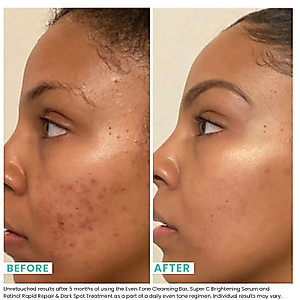 Urban Skin Rx® Even Tone Cleansing Bar | 3-in-1 Daily Cleanser, Exfoliator, and Brightening Mask Helps Diminish Uneven Skin Tone, Formulated with Kojic Acid, Azelaic Acid, and Niacinamide | 3.7 Oz