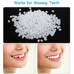 CAILING 6 Sets Instant Veneers Dentures, Teeth Covers for Bad Teeth for Snap Covering Missing Teeth Denture Filling Kit Super Smile Dentist