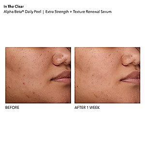 Dr. Dennis Gross In The Clear Retinol + AHA/BHA SetL Alpha Beta Extra Strength Daily Peel (14 Packettes) + Advanced Retinol + Ferulic Texture Renewal Serum (full size 1 oz)