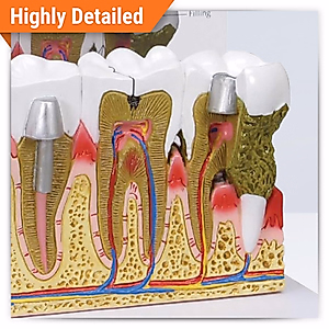 Dental Model | Human Body Anatomy Replica of Teeth w/Common Pathologies for Dentist Office Educational Tool | GPI Anatomicals