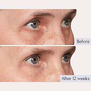 Tru Alchemy Eye Elixir Cooling Eye Treatment Cream - Dark Circle Eye Cream for Puffiness and Bags Under Eyes - Caffeine, Hyaluronic Acid, Vitamin C