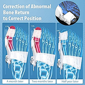 Donnetty Bunion Corrector for Women & Men, Orthopedic Toe Straightener, Adjustable Splint Bunion Pads Day Night Support with Toe Separator for Bunion Relief