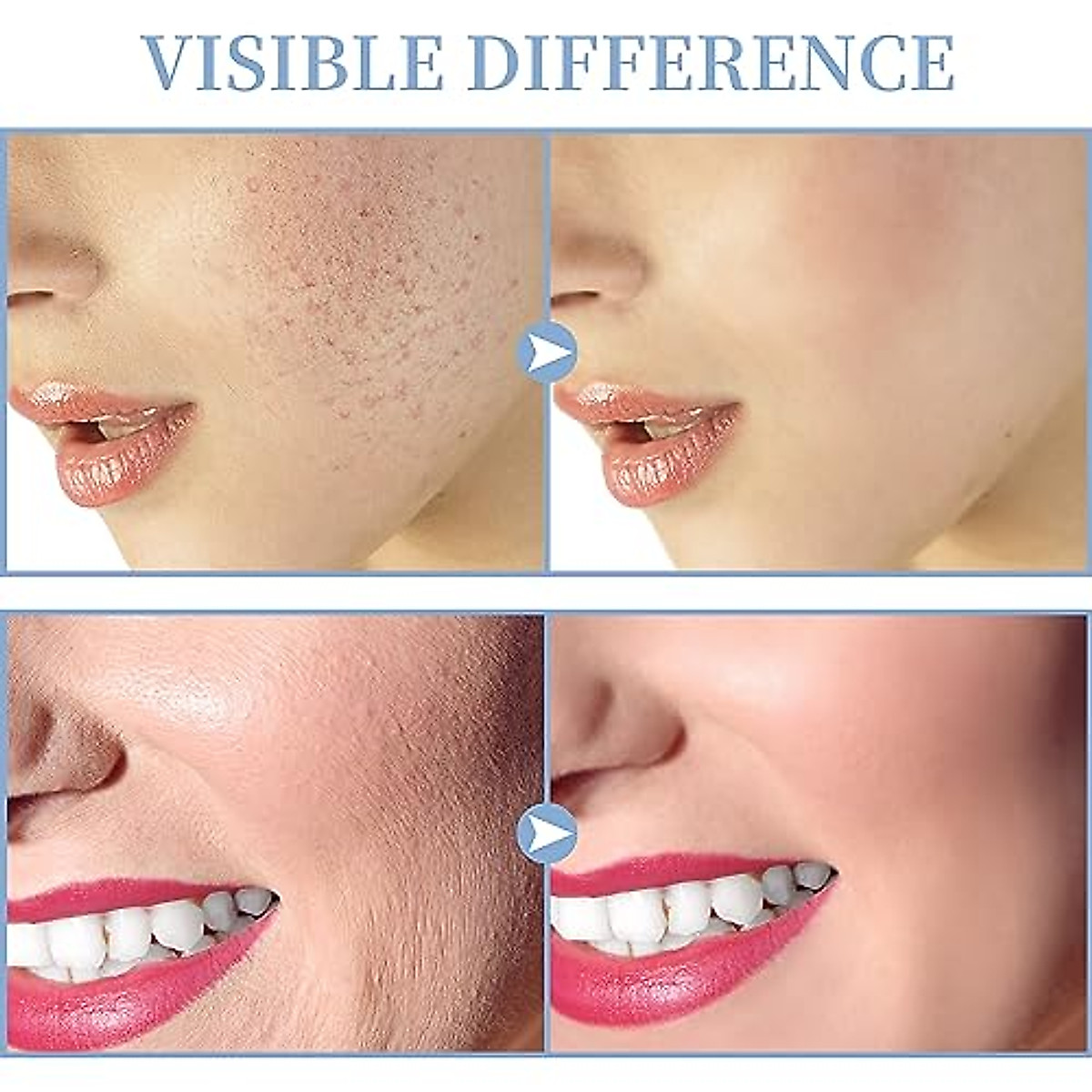 High Frequency Facial Machine - TUMAKOU Portable Handheld High Frequency Facial Skin Wand Machine with 4 Different Tubes