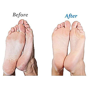 Emjoi Micro-Pedi 3D POWER Callus Remover with Xtreme Coarse Soft & Flexible Roller (Most Powerful & Corded)