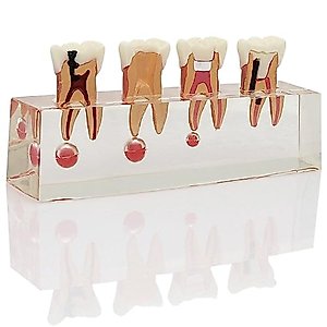 Dentalmall Dental 4-Stage Endodontic Treatment Model for Study Teach Teeth Model 4018 Root Canal Anatomy Demonstration Teaching Tooth Model