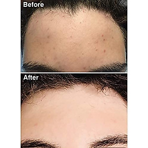 Teenology Leave-In Conditioning Detangler + Heat Protectant for Teens - Helps with Acne and Breakouts - Pink Grapefruit Scent 6 oz.