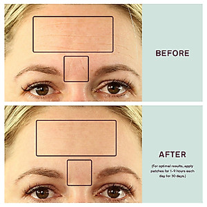 Dermaclara Forehead Patch - Forehead Wrinkle Patches for Face Overnight, Silicone Patches, Reusable Treatment for Wrinkles, Repair & Restore, Up to 30 Uses - 1 Patch
