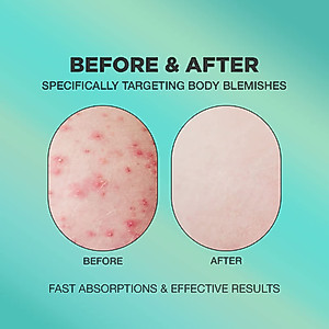 Butt Acne Cream | Butt Acne Cream for Body Blemishes | Butt Acne Cream Formulated with Natural Formula | Butt Acne Clearing Treatment Lotion | Butt Acne Spot Cream Targeting Stubborn Blemishes