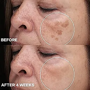 CITYGOO Dark Spot Remover for Face and Body, Dark Spot Corrector Cream, Melasma Treatment for Face, Hyperpigmentation Treatment, Freckle Remover With Tranexamic acid, Niacinamide, Squalane and Vitamin E Serum-1.7 FL OZ