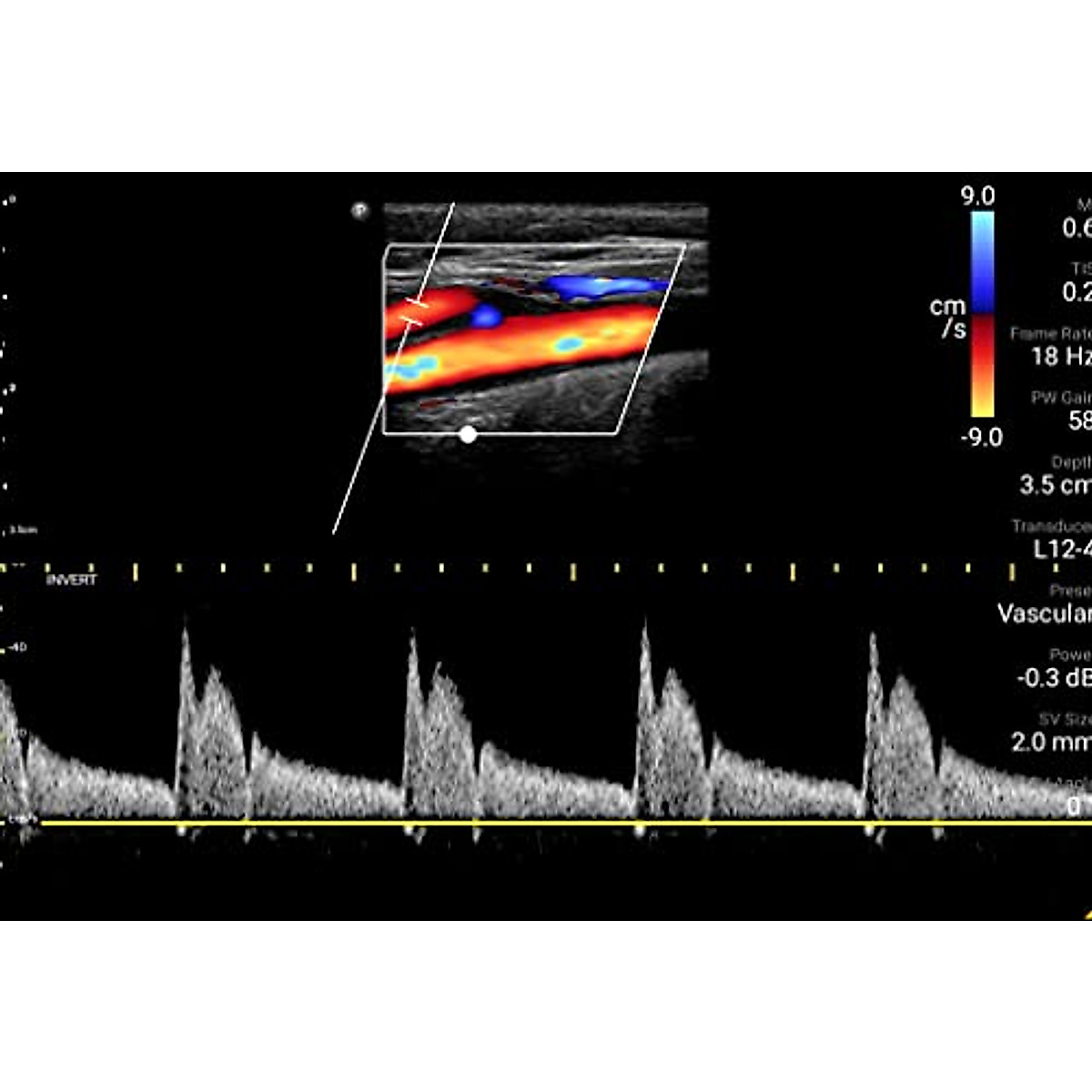Philips FUS6882 Lumify L12-4 Linear Array Transducer, Portable Ultrasound Solution