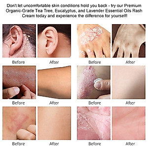 UEUEKOKO Eczema Psoriasis Manuka Relief Honey Cream, Hand Foot, Tinea Versicolor, Itchy Feet, Butt, Anal Itch, Scalp Dandruff, Bee Sting, Bites, Boil Cyst, Armpit, Adults Kids, Hidradenitis Treat